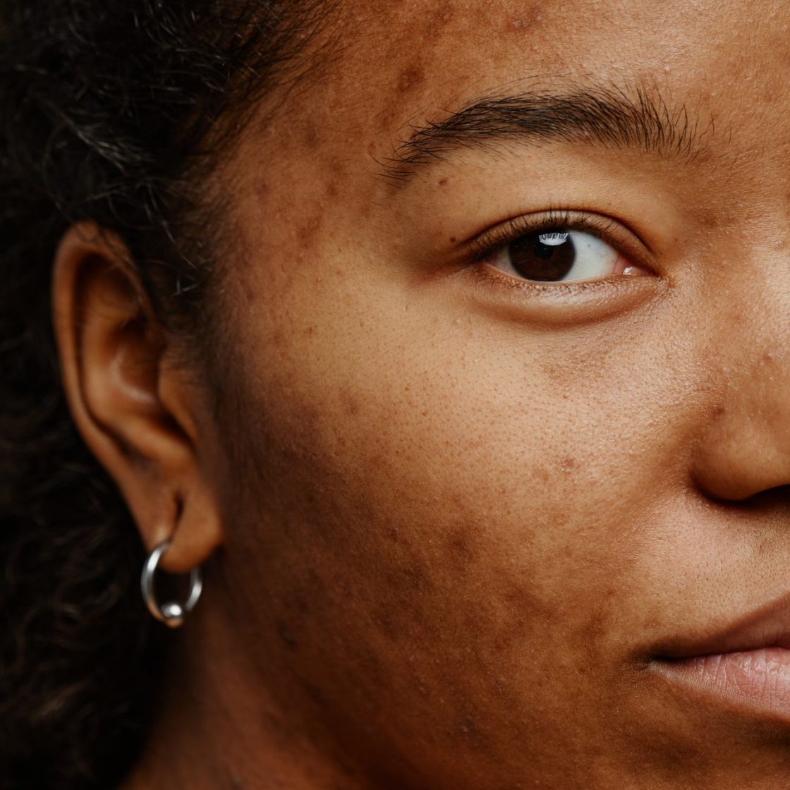 Whats The Difference Between Cystic And Hormonal Acne