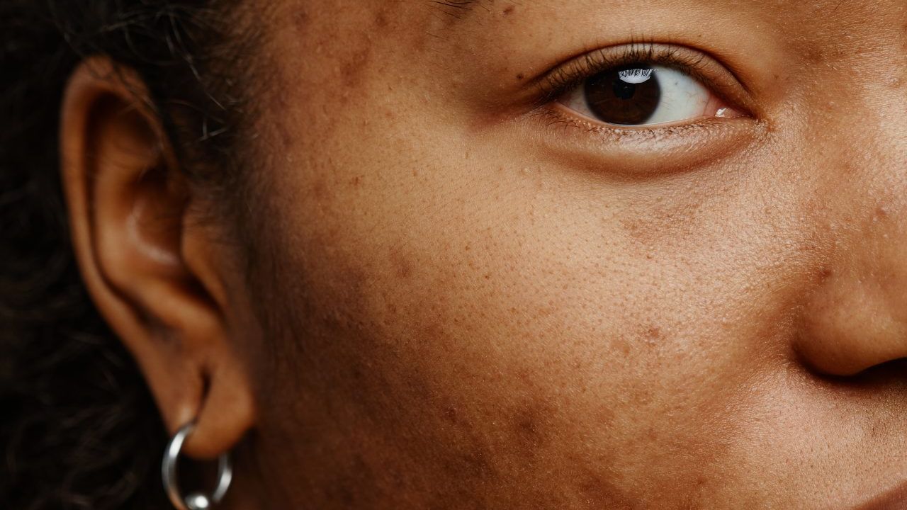 Whats The Difference Between Cystic And Hormonal Acne